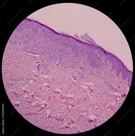 Photo Stock Skin Tissue Biopsy Lichen Planus Show Skin Tissue