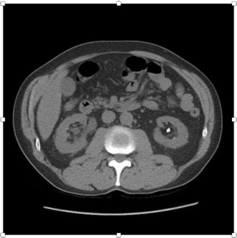 Gray Scale Image Figure 15 Threshold Segmentation Image Download