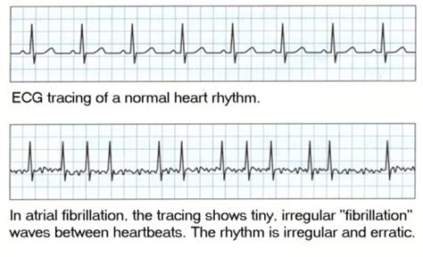 Diagnosis And Treatment Of Atrial Fibrillation Chest Heart And Stroke