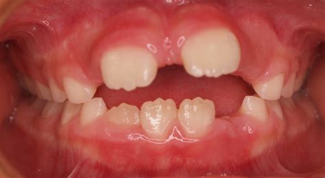 Pacifier Teeth Open Bite At Lauren Blackwell Blog