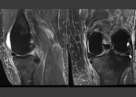 Medial Meniscus Tear Horizontal Right Leg Type 1
