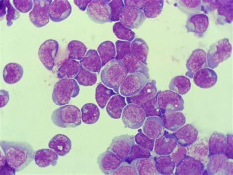 Central Nervous System Infiltration By T Lymphoblastic Lymphoma