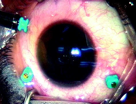 Sutureless Vitrectomy Evolution And Current Practices British Journal Of Ophthalmology