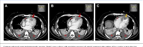 Figure 4 From Metastatic Penile Squamous Cell Carcinoma Semantic Scholar