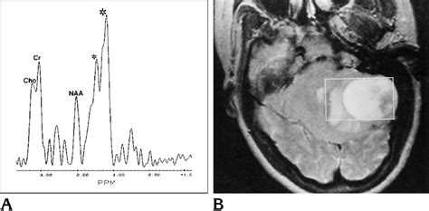 Metastasis A Single Volume Proton Mr Spectroscopy In A Solitary Brain