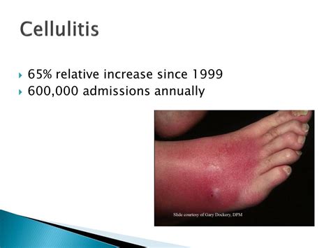 Ppt Inpatient Skin And Soft Tissue Infections Powerpoint Presentation