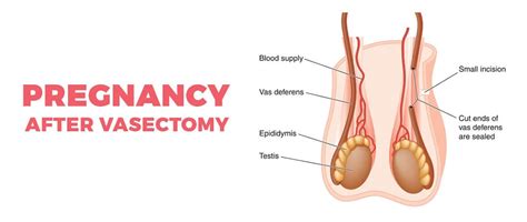 Male Fertility Testing After Vasectomy American Pregnancy Association
