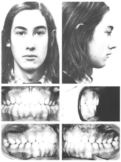 17 Class Ii 1 Subdivision Lateral Tongue Interposition Asymmetric Cervical Headgear Brackets