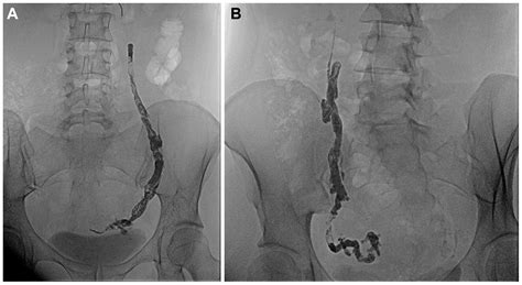 Efficacy And Safety Of Ovarian Vein Embolization With N Butyl 2