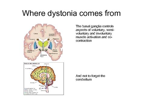 Spasticity And Dystonia From Neurology Perspective Dr Ram