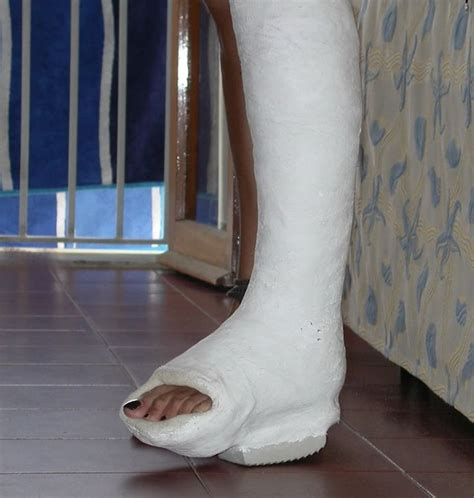 Plaster Walkingcast 1970s 1980s Leg Cast Art Ideas Plaster Cloth