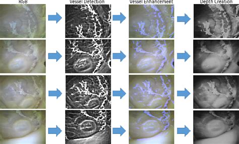 Magnetic Visual Sensor Fusion Based Dense 3d Reconstruction And Localization For Endoscopic