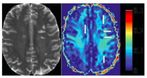 Terri Schiavo Brain Scan