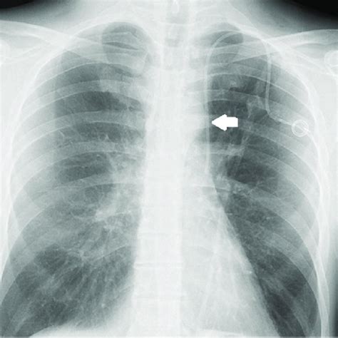 Jugular Vein Catheter X Ray At Clyde Rucker Blog