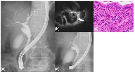 A Case Of Eosinophilic Cholangitis Without Bile Duct Stenosis Diagnosed By Bile Duct Biopsy
