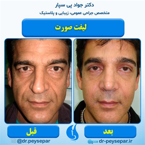 لیفت صورت چیست؟ دکتر جواد پی سپار