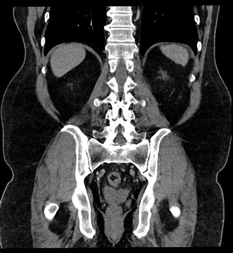 Fileigg4 Related Autoimmune Cholangitis Pancreatitis And Pseudotumor