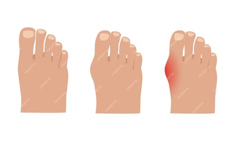Premium Vector Hallux Valgus Valgus Deformity Of The Big Toe Joint