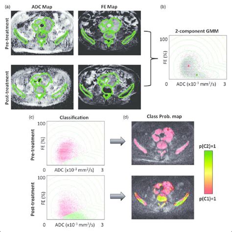 image analysis for a prostate patient bone metastases with no