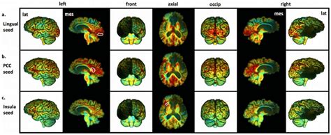 Rs Functional Connectivity Results Unthresholded Images Showing Download Scientific Diagram