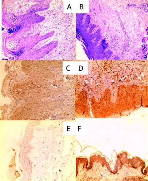 Aa Case Of Psoriasis Showed Hyperkeratosis Parakeratosis