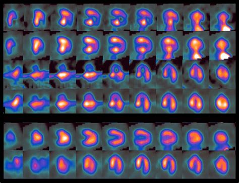 What Is This Image 2019 Image 4 Journal Of Nuclear Cardiology