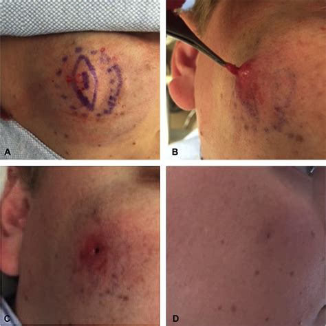 Epidermal Inclusion Cyst Removal Medpics Uc San Diego School Of
