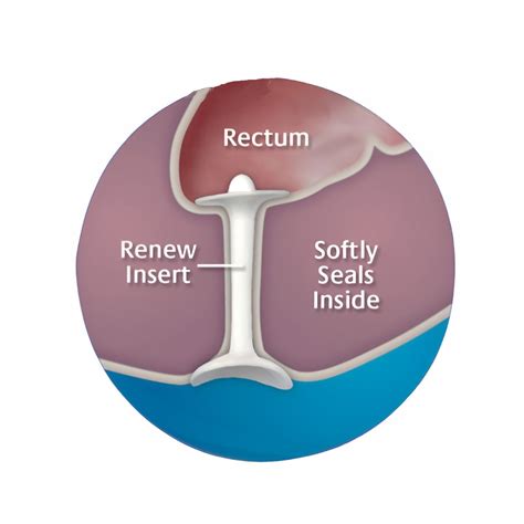 Renew Insert Anal Plug With Hygienic Touch Free Applicator
