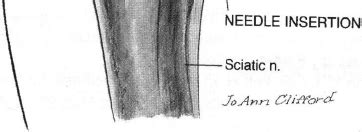 Sciatic Nerve Block Anterior Technique Reprinted With Permission From Download Scientific