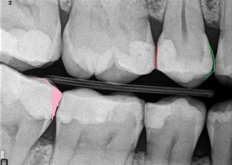 Limitations Of Tofflemire Bands