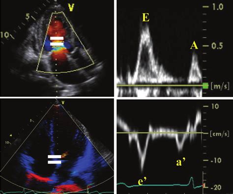 Assessment Of Left Ventricular Diastolic Function A Transmitral Flow