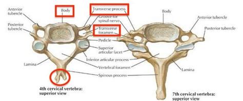 Bifurcated Spinous Process