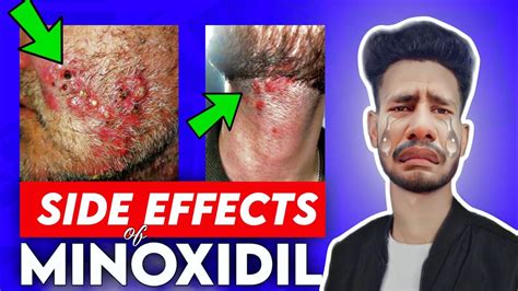 Minoxidil Beard Side Effects Side Effects Of Minoxidil Beard