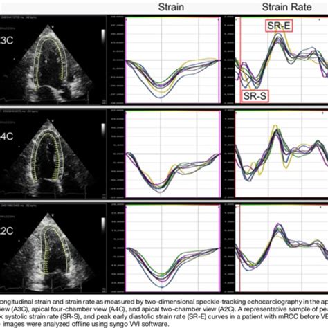 Algorithm For The Assessment Of Diastolic Function Modified From The