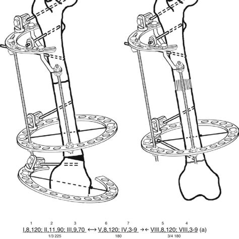 134 Epiphysiodesis Of The Proximal Tibia A Insertion Of The K Wire Download Scientific