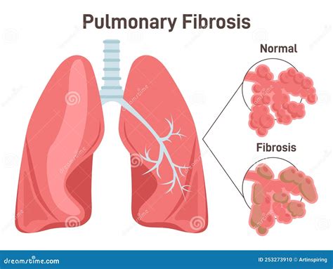 Pulmonary Fibrosis Awareness Month Vector Banner Poster Card For