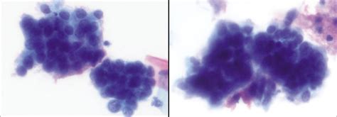 Atypical Glandular Cells Agc Cytology Of Glandular Lesions Of The