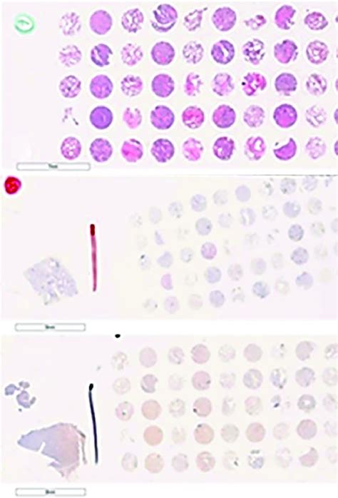 Tissue Microarray Slides Stained For Hande Her2 Cep17 Dish And C Myc Download Scientific