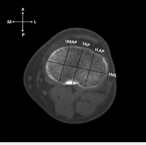 Axial Ct Image Of The Proximal Tibia Showing Mediolateral Length Tml Download Scientific