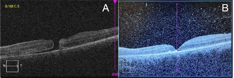 OCT Of The Macula A OCT Demonstrating Full Thickness Macular Hole At Download Scientific