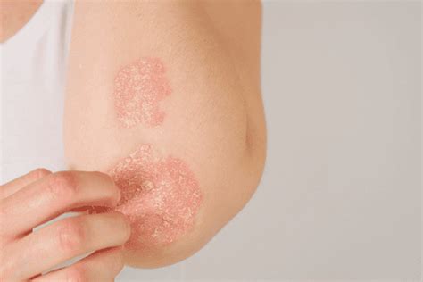 Psoriasis Qué Es Síntomas Y Tratamientos