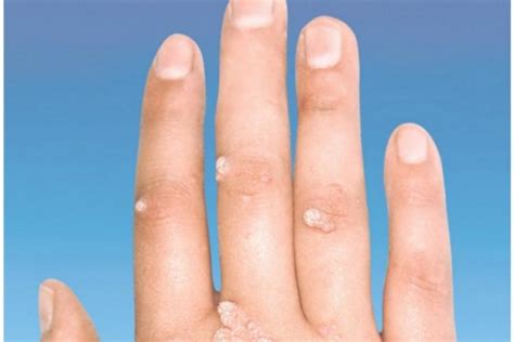 Бородавка Куриная Жопка Фото — Картинки фотографии