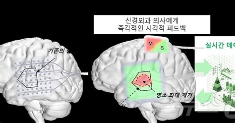 뇌수술 성공률 향상 Unist 마이크로 Led 디스플레이로 뇌 실시간 모니터링