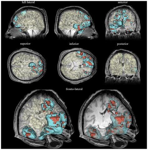 Three Dimensional Models Of Semi Automatically Segmented Download Scientific Diagram