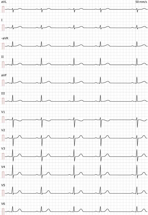 Sinus Arrhythmia Respiratory Sinus Arrhythmia The Cardiovascular