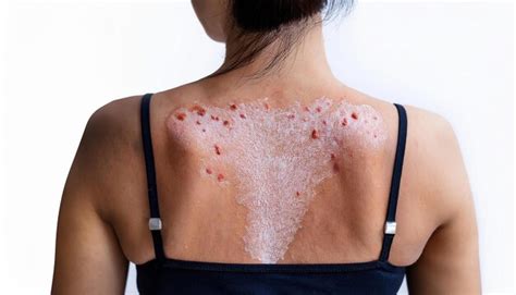 Lower Back Psoriasis Images Free Download On Freepik