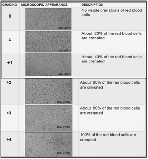 Grading Scale For Degree Of Red Blood Cell Crenation Download