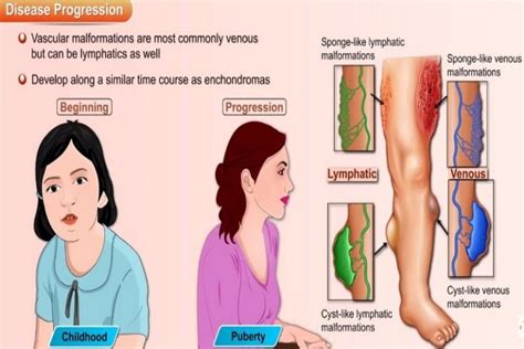Maffucci Syndrome Symptoms Causes And Treatment