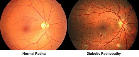 machinex diabetic retinopathy detection using ai by knoldus inc