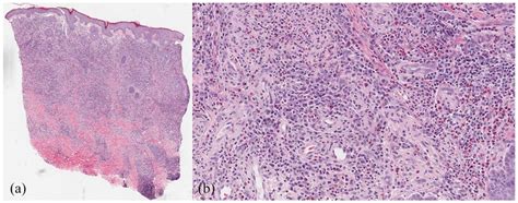 A A Diffuse Dermal Infiltrate Extends Into The Deep Dermis Download Scientific Diagram